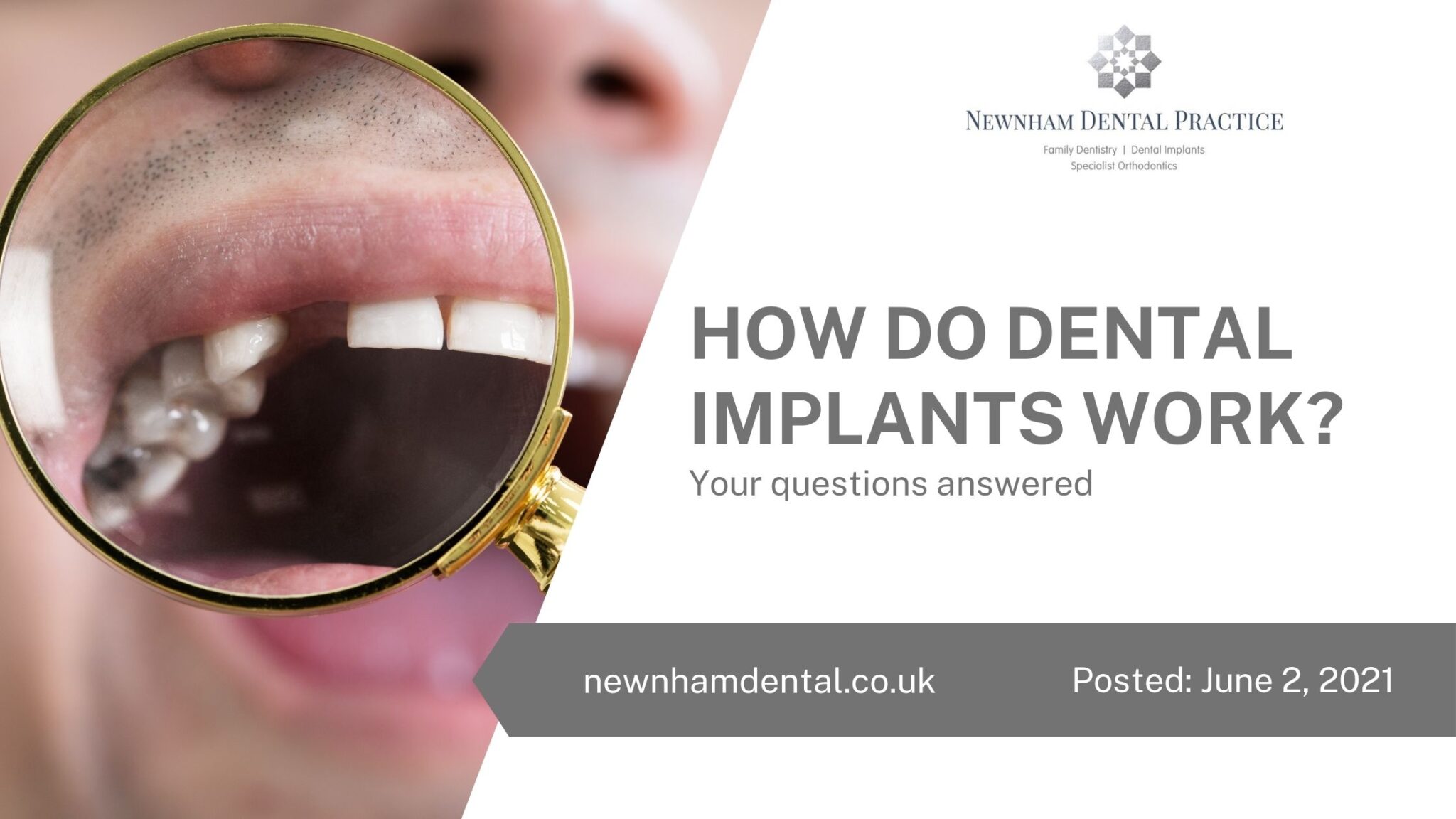 How Do Dental Implants Work? – Newnham Dental