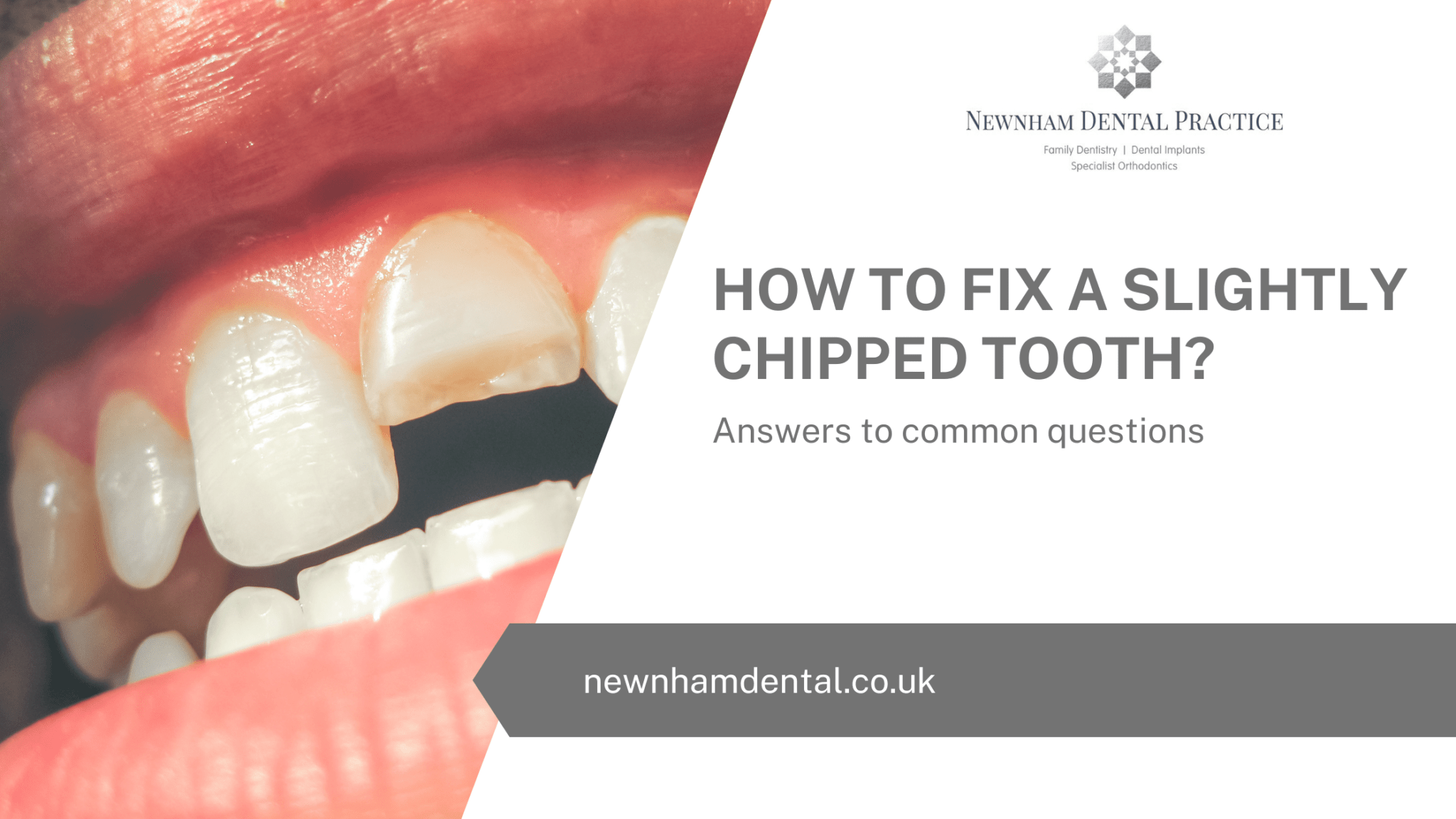 How To Fix A Slightly Chipped Tooth? | Newnham Dental