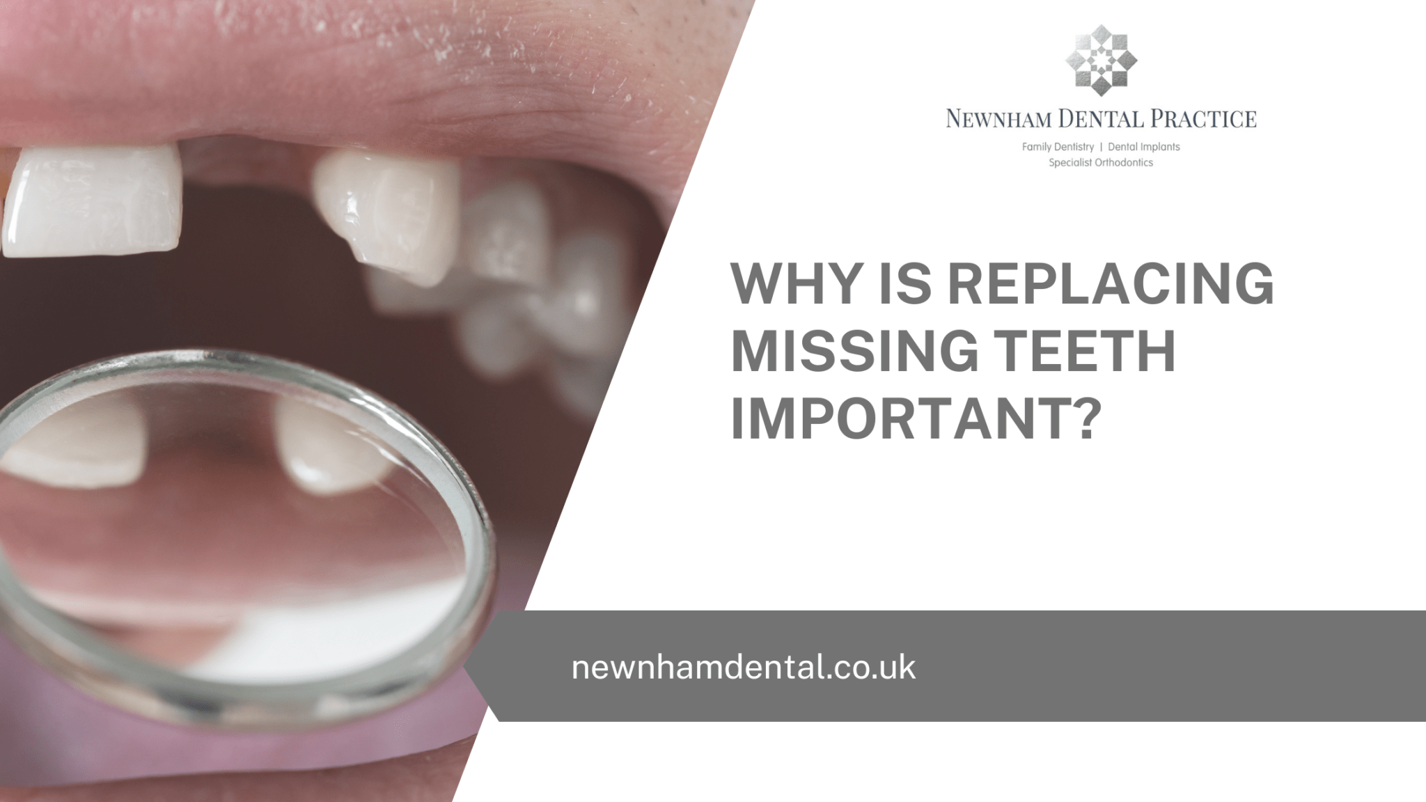 Why Is Replacing Missing Teeth Important? | Newnham Dental